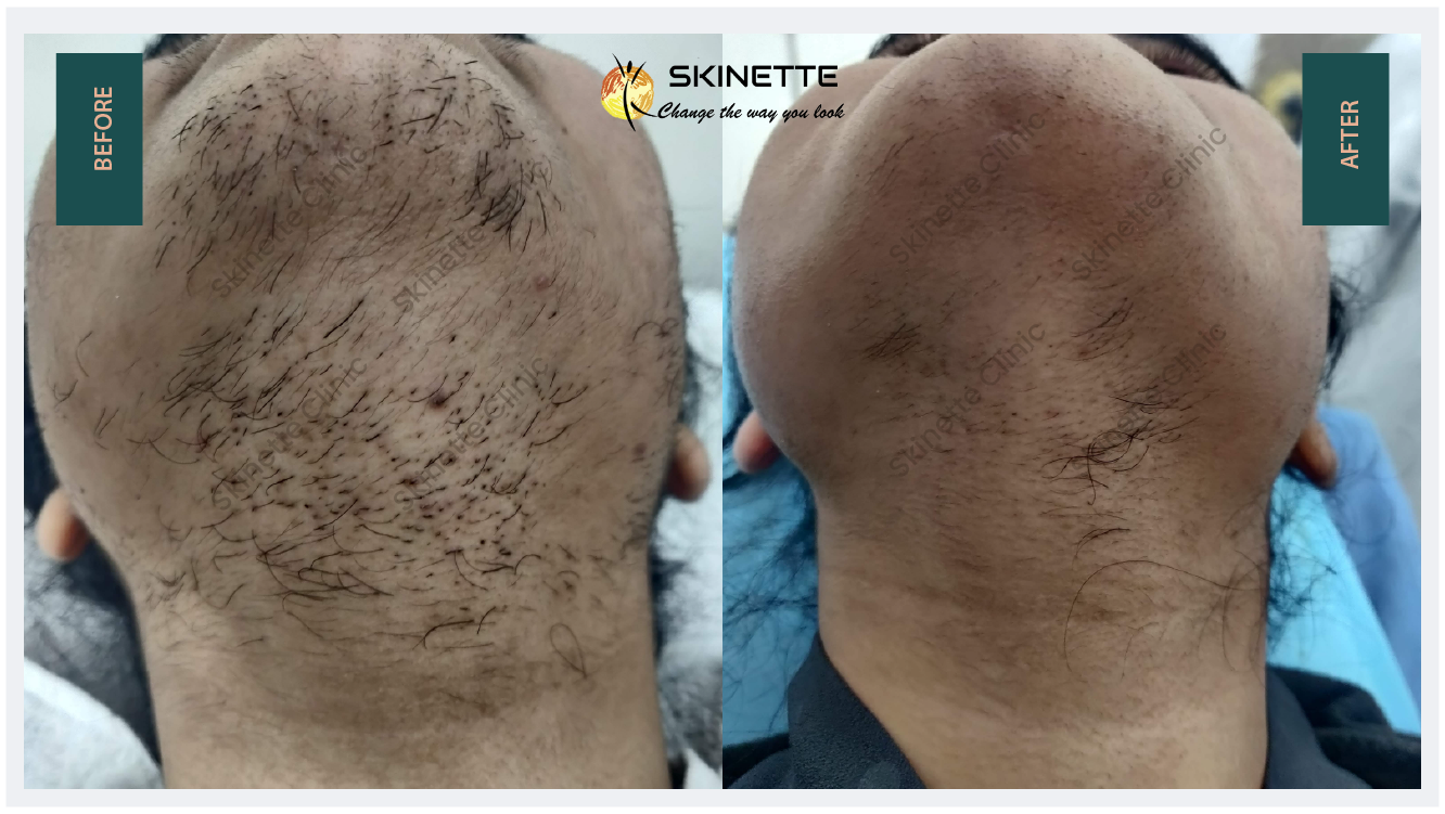 Laser Hair Removal Before After Results Skinette Laser Hair Removal Before After Results Skinette